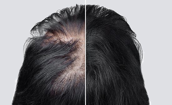 증가하는 여성 탈모 원인은?... 호르몬 변화의 영향 커 ① [인터뷰]